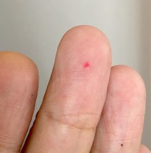 Snakebite Symptoms | Symptom Information | Thailand Snakes